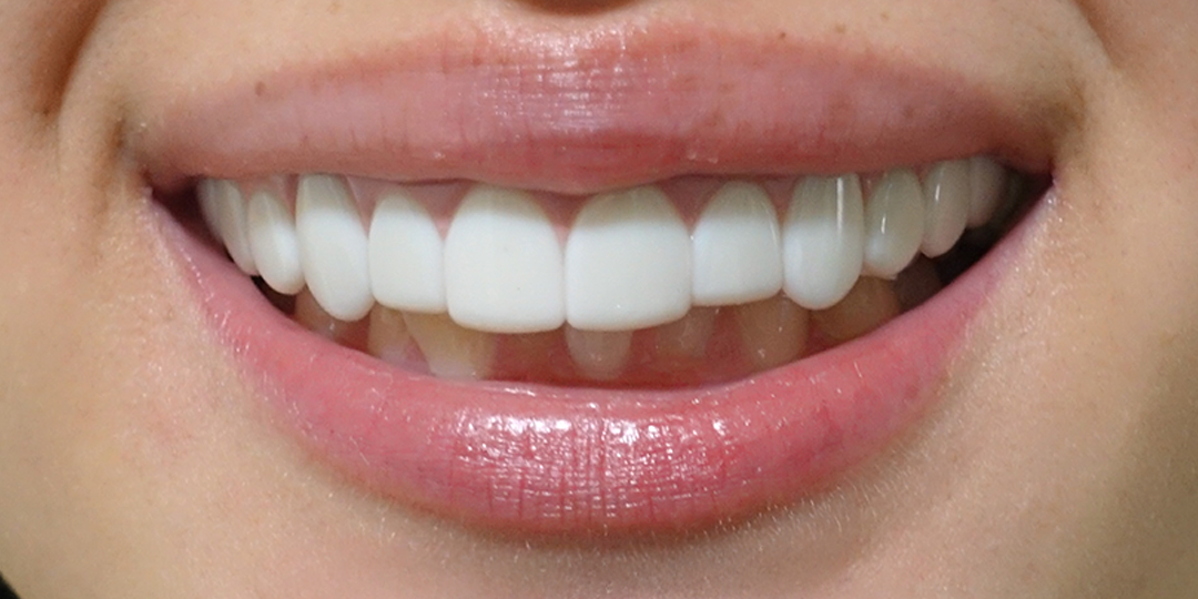 Imako® Cosmetic Teeth – Refill Kit