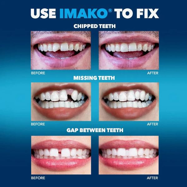 Imako® Tooth Tinted Plastic – Temporary Tooth – For Chipped Tooth & Fi