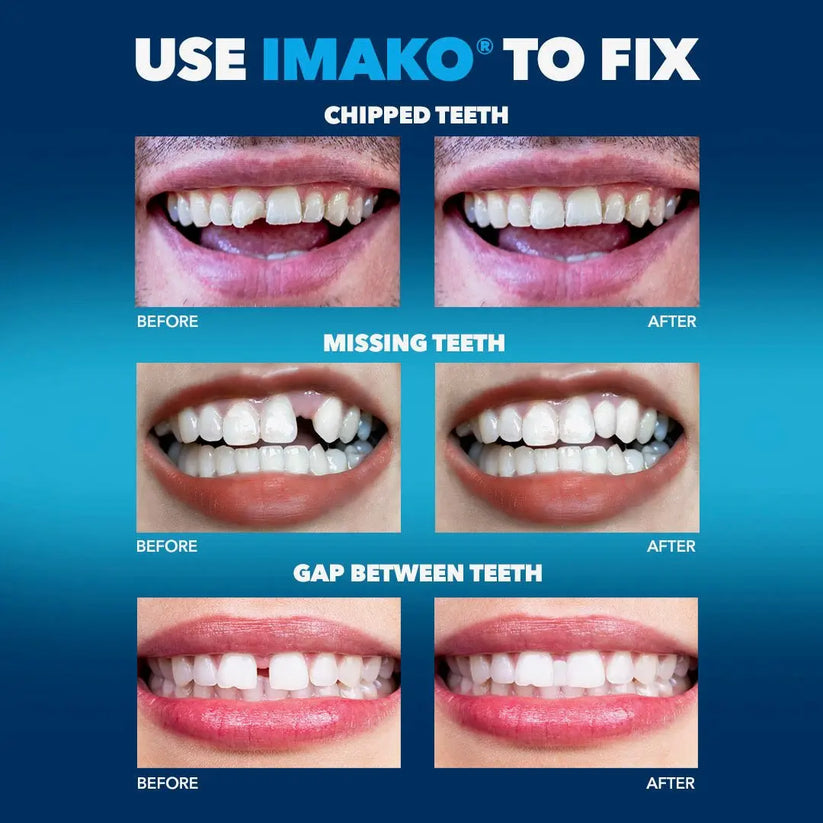 Imako® Tooth Tinted Plastic – Temporary Tooth – For Chipped Tooth & Fi